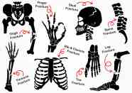 Identifying Bone Fractures After A Car Accident Injured Call Today Identifying Bone Fractures After A Car Accident Injured Call Today